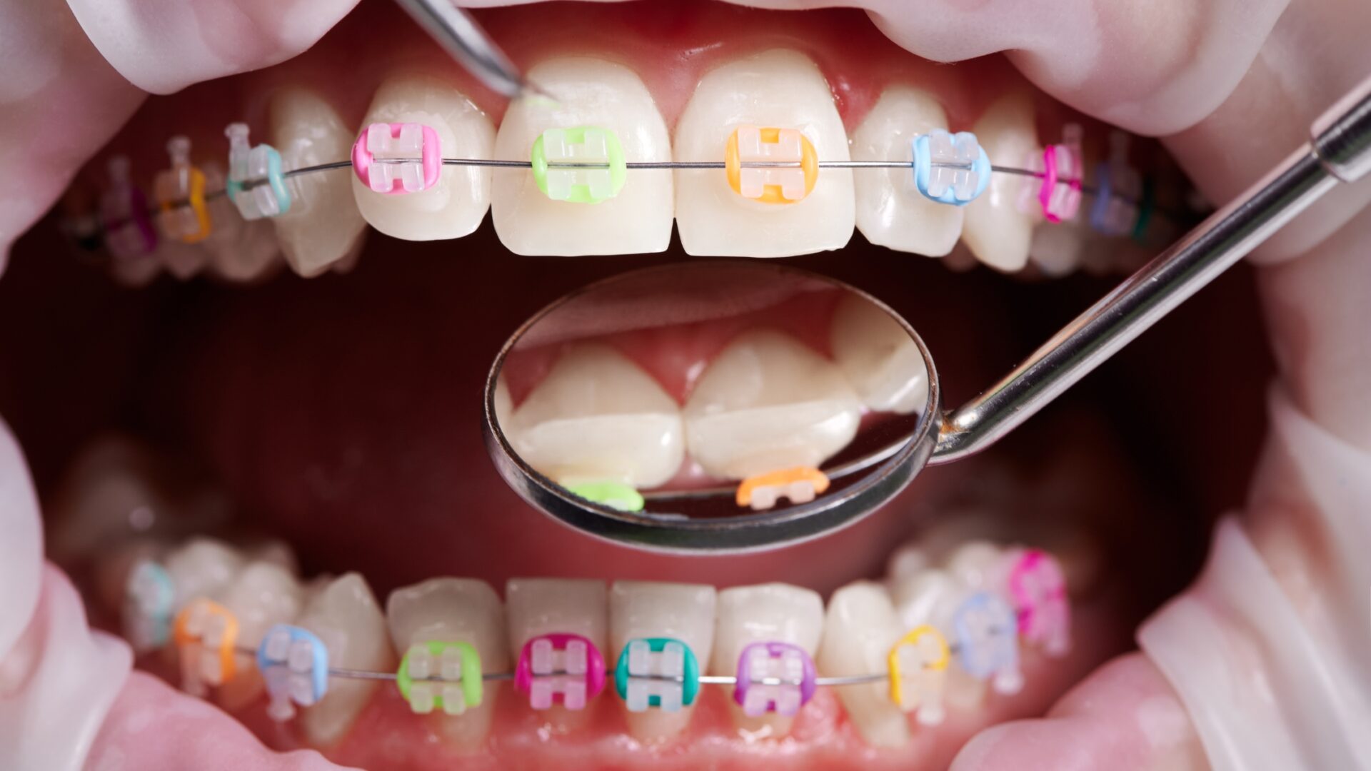 Best Braces Colours: Choosing the Right Shade For Your Smile - Top 10 ...